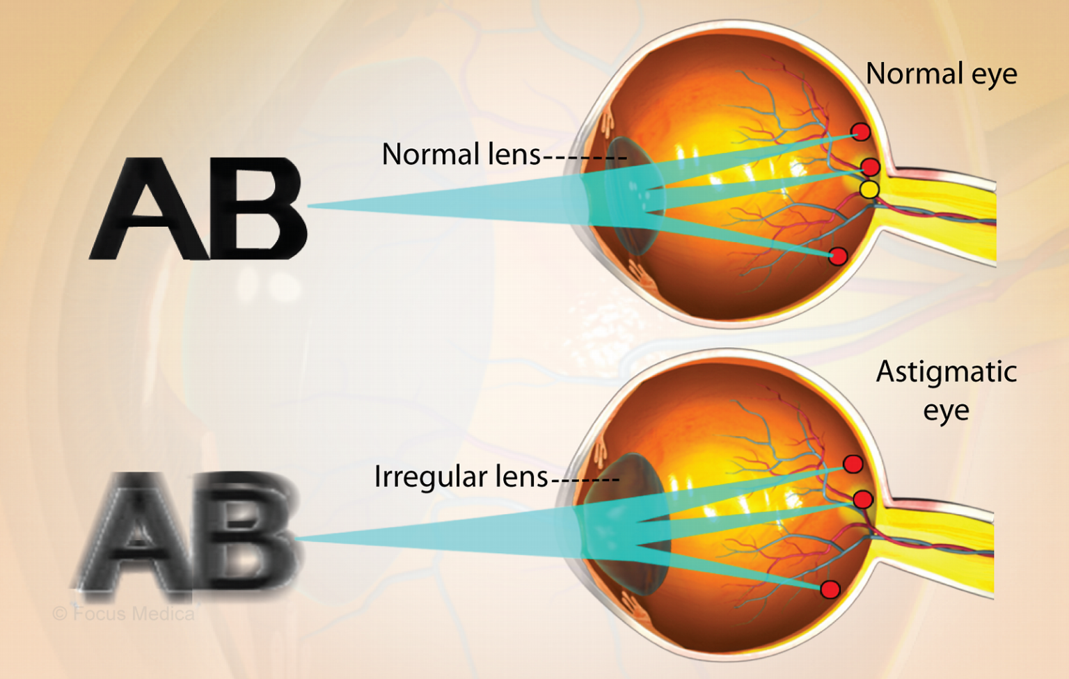 Astigmat Nedir? Astigmat Dereceleri, Bebeklerde Astigmat